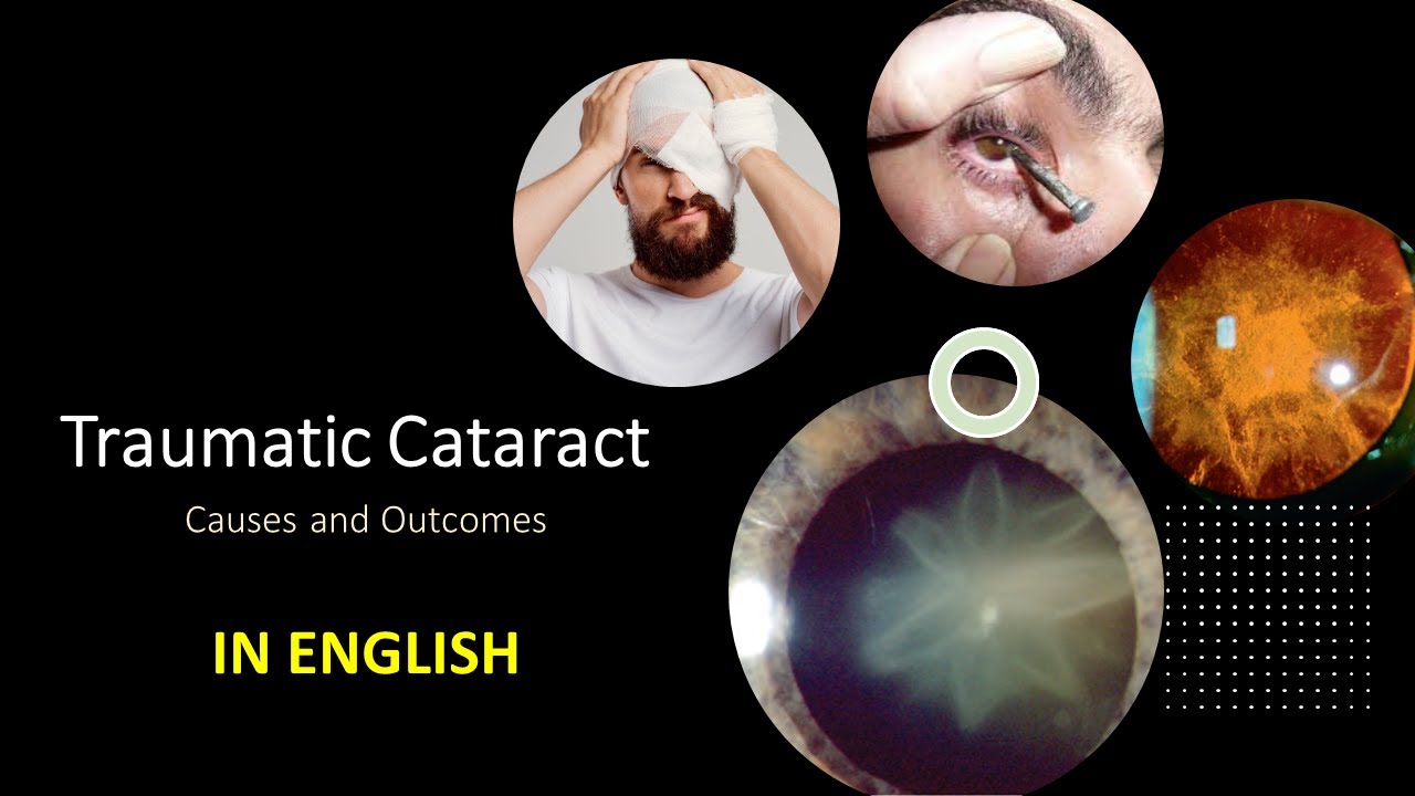 TRAUMATIC CATARACT | IN ENGLISH