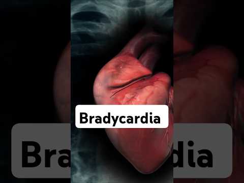 What is Bradycardia #Bradycardia #Heart #Health