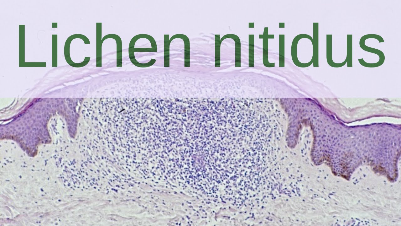 Lichen Nitidus - Pathology mini tutorials