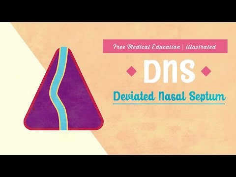 What is Deviated Nasal Septum (DNS)?