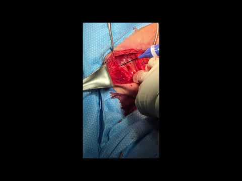 Lymph Node Dissection Near Axillary Nerve