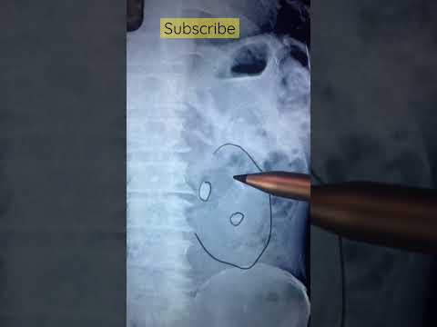 X RAY OF ACUTE ABDOMEN | UROLITHIASIS | ytshorts #ytshorts #tiktok