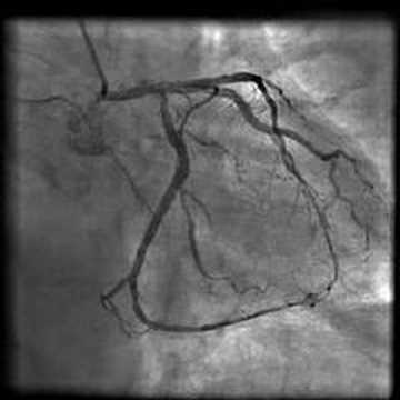 Coronary Angiogram, Angioplasty & Stenting | Isuru Suriarachchi's Blog