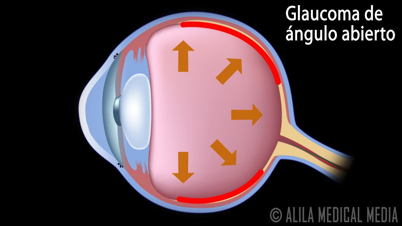 Open-Angle and Closed-Angle Glaucoma, Animation. Alila Medical Media Spanish.