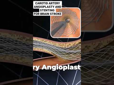 TREATMENT OF BRAIN STROKE | PREVENTION OF BRAIN STROKE | CAROTID ARTERY ANGIOPLASTY & STENTING |