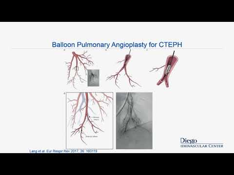 Interventional Treatment of Chronic Thromboembolic Pulmonary Hypertension - Ehtisham Mahmud, MD