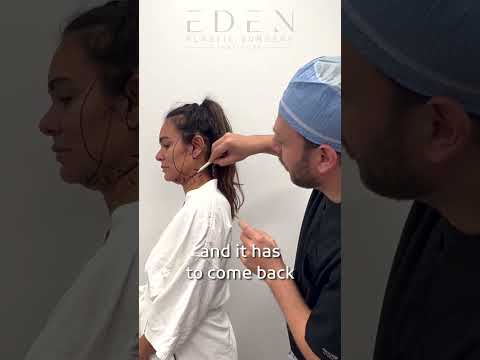 EVE Lift™️Facelift, Neck Lift | Eden Plastic Surgery: Ali Charafeddine, MD