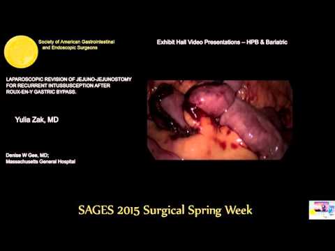 LAPAROSCOPIC REVISION OF JEJUNO JEJUNOSTOMY FOR RECURRENT INTUSSUSCEPTION AFTER ROUX ENY GASTRIC BYP