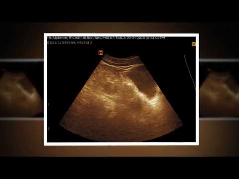 Ultrasound cases 452 of 2000 || Right Ectopic Kidney