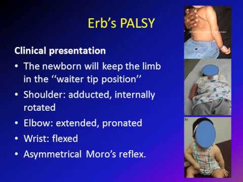 Obstetric Brachial Plexus Palsy (OBPP)/ Erb’s Palsy – Birth Trauma