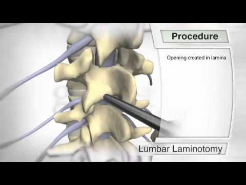 Lumbar Laminotomy Procedure