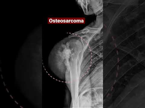 Osteosarcoma of the humerus 🦴🦴 #xray #bones #medical