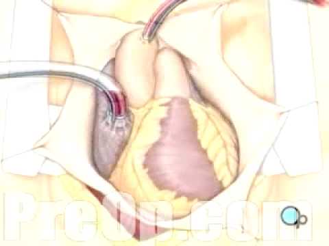 PreOp® Patient Education Coronary Artery Bypass Graft