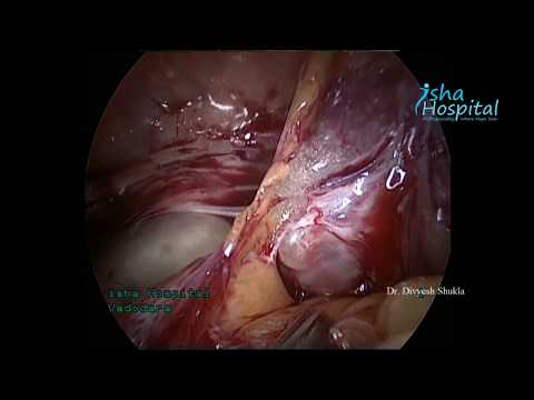 Post hysterectomy POD Adhesions
