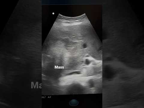 Liver Mass/ Malignancy Ultrasound | Sonography, #cancer #ardms #sonographer #abdomen