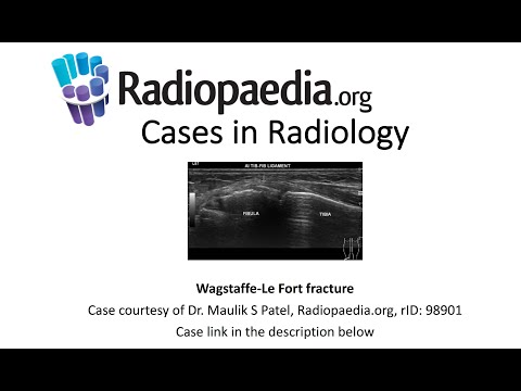 Wagstaffe-Le Fort fracture (Radiopaedia.org) Cases in Radiology