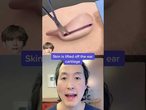 Watch How Ear Pinning (Otoplasty) Surgery Works! #shorts #otoplasty