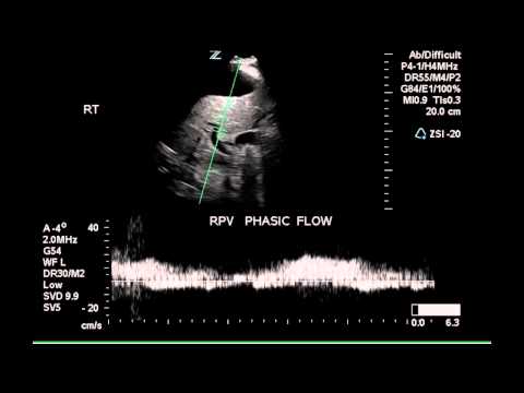 Abnormal Hepatic Venous Flow - Case Study