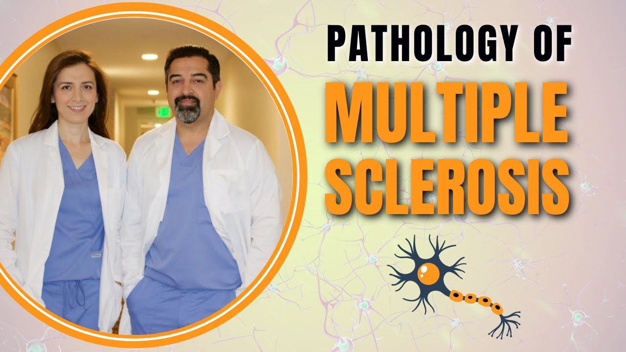Inside the Brain: Understanding the Pathology of Multiple Sclerosis