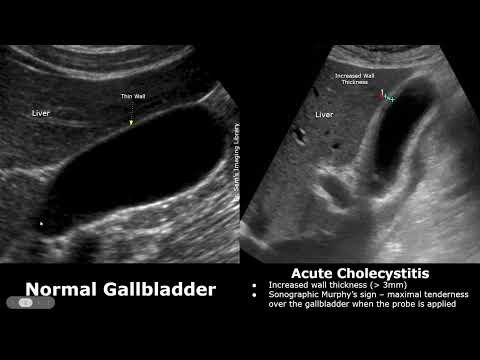 Gallbladder Ultrasound Normal Vs Acute Cholecystitis | Gallstones, Sludge, Thickened GB Wall USG