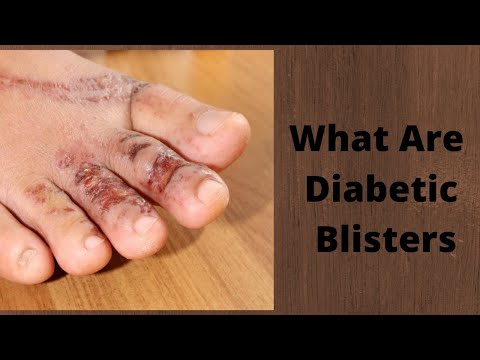 What Are Diabetic Blisters