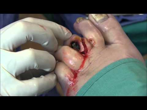 Toe Amputation By Dr. James Kent