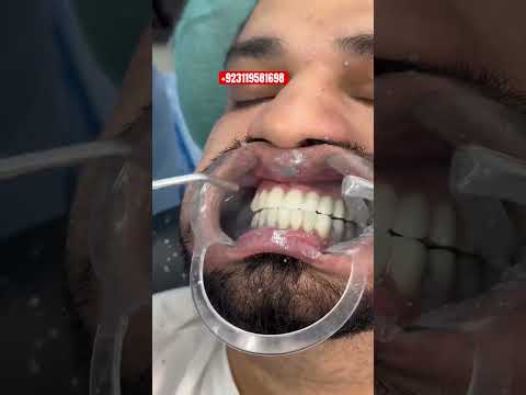 Teeth whitening powder 🦷💎🦷👀 #love #doctor #teethwhiteningpowder #teethdecay #dentist #funny #
