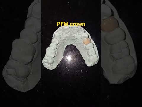 PFM #bdsmcommunity #MDS #dentistry #teeth #prosthodontic #prostho #prostholife #endodontics