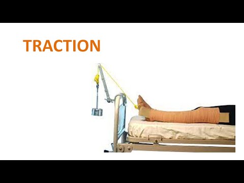 Traction: Principles, Types, Skin & Skeletal, Fixed & Sliding (Full guide)