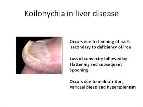 Koilonychia and Dupuytren's contracture in liver disease