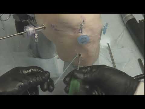 Posterior Cruciate Ligament Repair With Suture Tape Augmentation