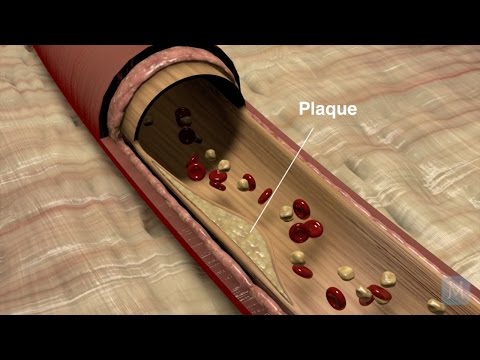 What Is Coronary Artery Disease (CAD)? | Match Health