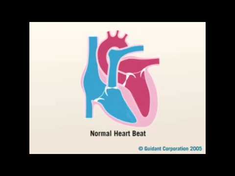Demonstration of Bradycardia