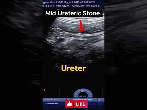 Ultrasound Tracing the mid Ureteric Stone #ultrasound #stone #calculus