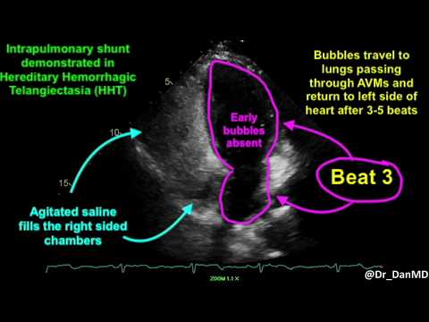 Pulmonary Arteriovenous Malformations (AVMs) in HHT