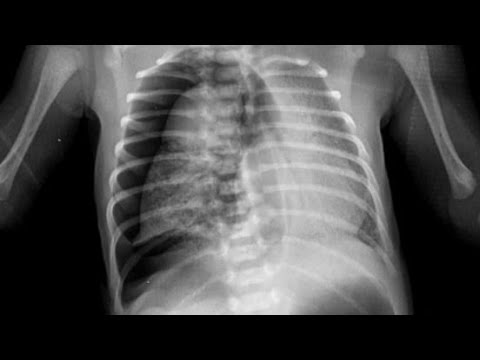 pneumothorax ultrasound in a newborn with RDS