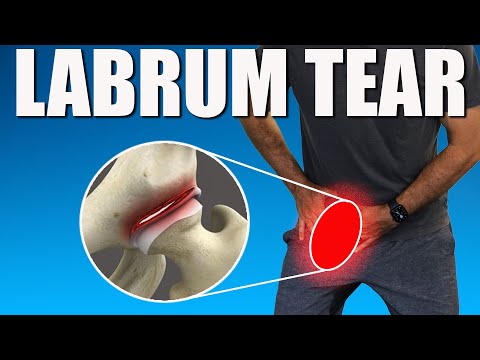 HIP LABRUM TEAR. BEST Exercises, Stretches & Advice for Hip & Groin Pain Relief