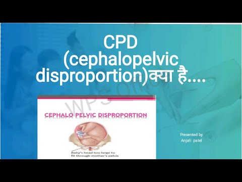 CPD || CEPHALO PELVIC DISPROPORTION || DIFFICULTY IN ENGAGMENT