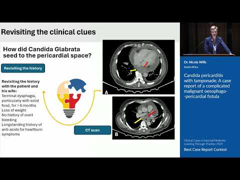 Candida pericarditis with tamponade: Report of a complicated malignant oesophago-pericardial fistula