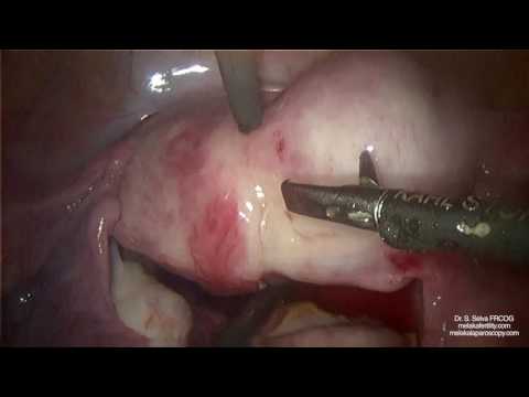 Video 11 2 Excision of non communicating uterine horn