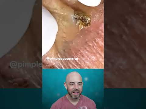 This cyst doesn’t go quietly 👀💥 You won’t want to miss it! (credit: @pimplepoppersus on TT) #cyst