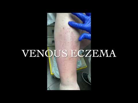 Venous Stasis, Venous Eczema & Venous Insufficiency!
