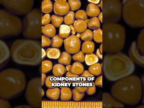 The Astonishing Powers of Citric Acid Unlocking its Secrets for Kidney Stone Prevention