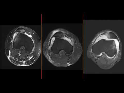 Knee MRI: Recurrent patellar subluxation