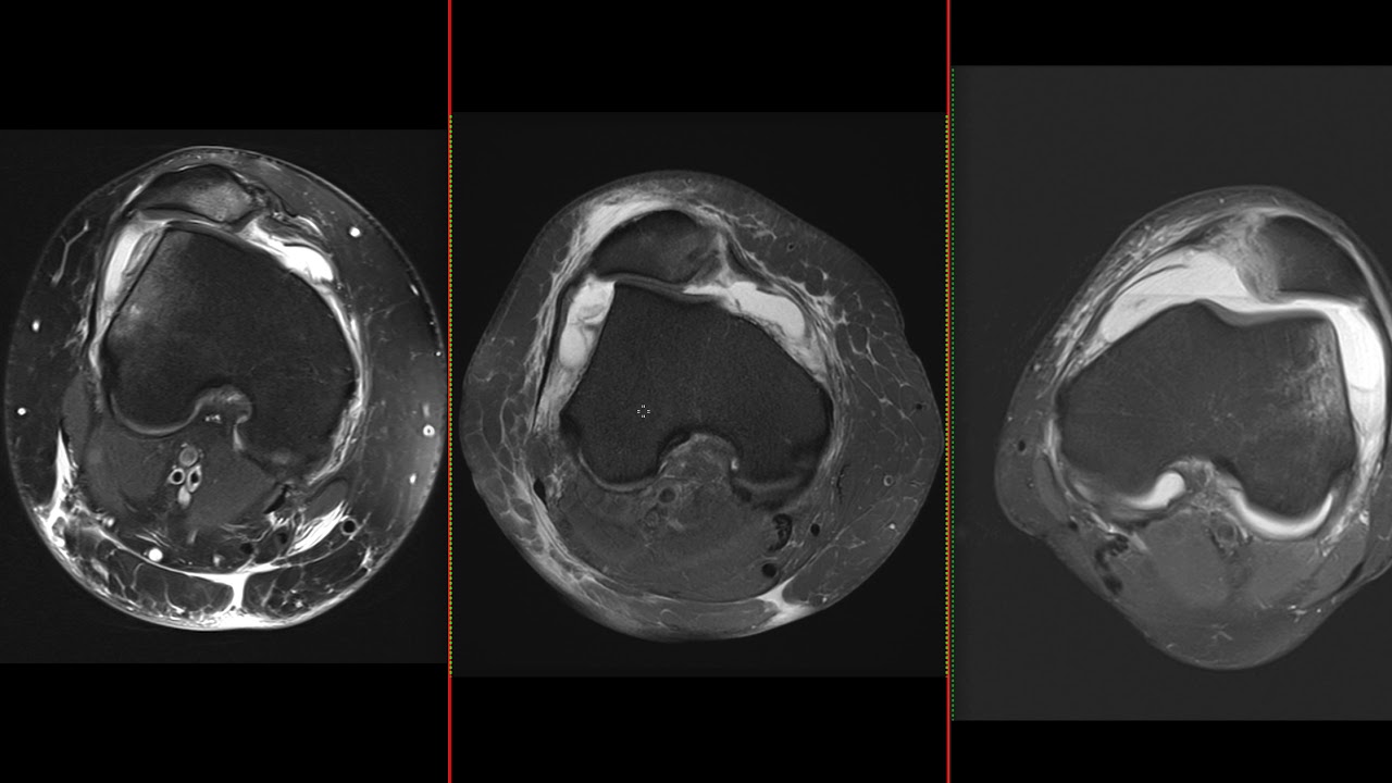 Knee MRI: Recurrent patellar subluxation