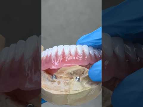 Upper and Lower Locator #Denture #dental #teeth #smile #dentures #lsk121shorts #shortvideo #shorts