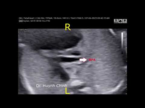 Pulmonary arteriovenous malformations and HHLS