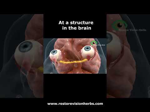 Overview of Optic Nerve Disorders - The Retina and Optic Nerve
