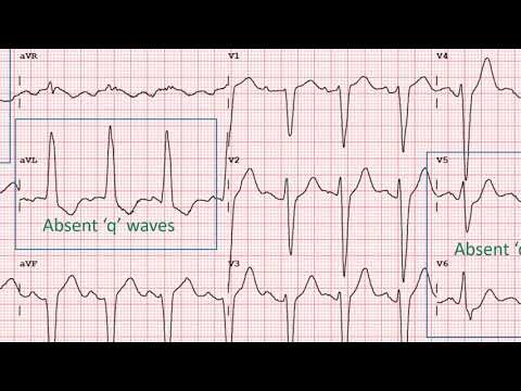 How to identify Left Bundle Branch Block in an ECG?
