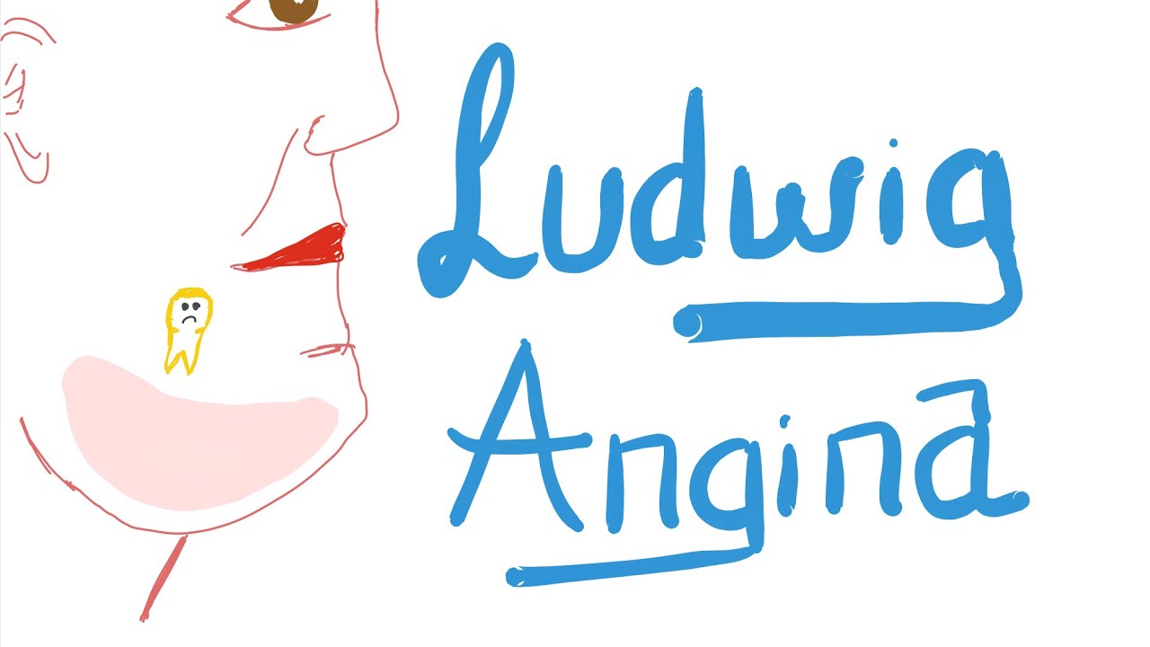 Ludwig Angina | 🚑 | Causes, Clinical Picture, Diagnosis and Management